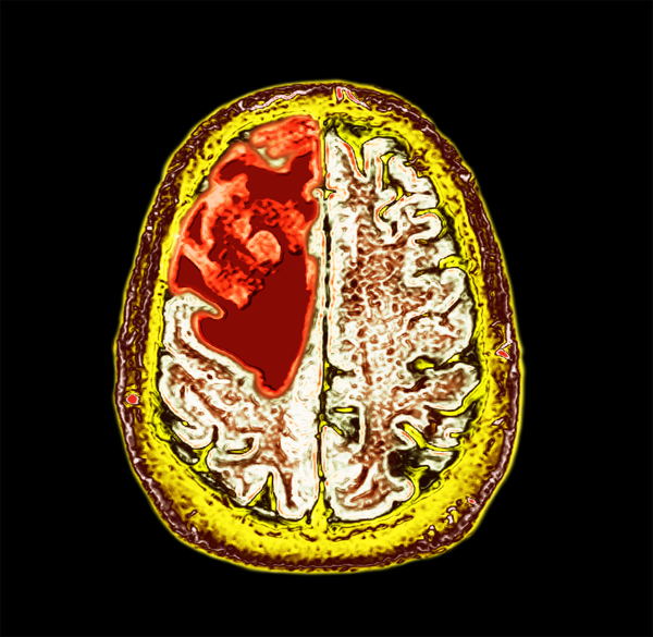 New Test Determines How Best To Treat Brain Tumours